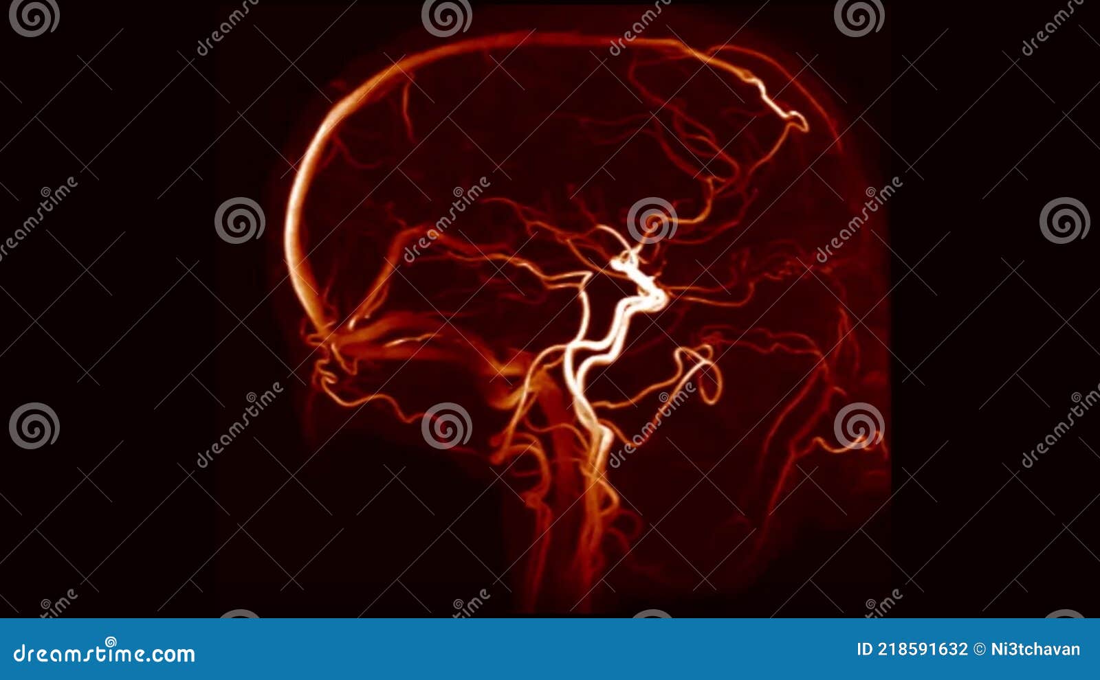 CTA Brain or Computed Tomography Angiography of the Brain 3D Rendering ...