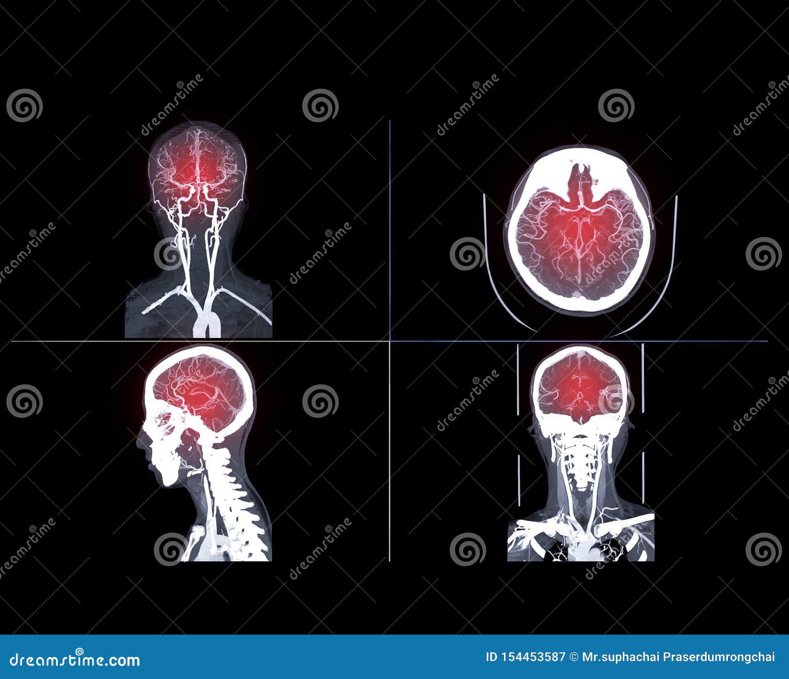 CTA Brain or CT Angiography of the Brain Stock Image - Image of ... CTA Brain or CT Angiography of the Brain Stock Image - Image of ...