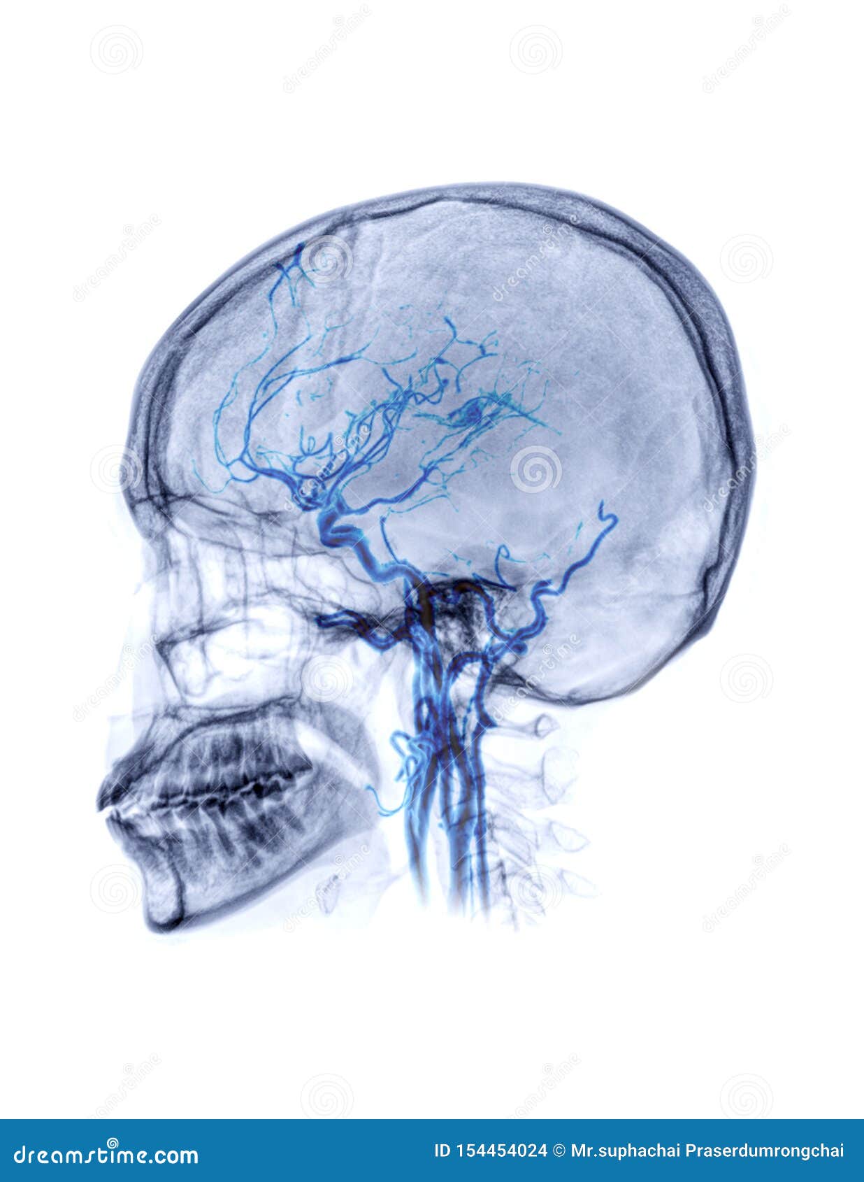 CTA Brain or CT Angiography of the Brain. Stock Photo - Image of ... CTA Brain or CT Angiography of the Brain. Stock Photo - Image of ...