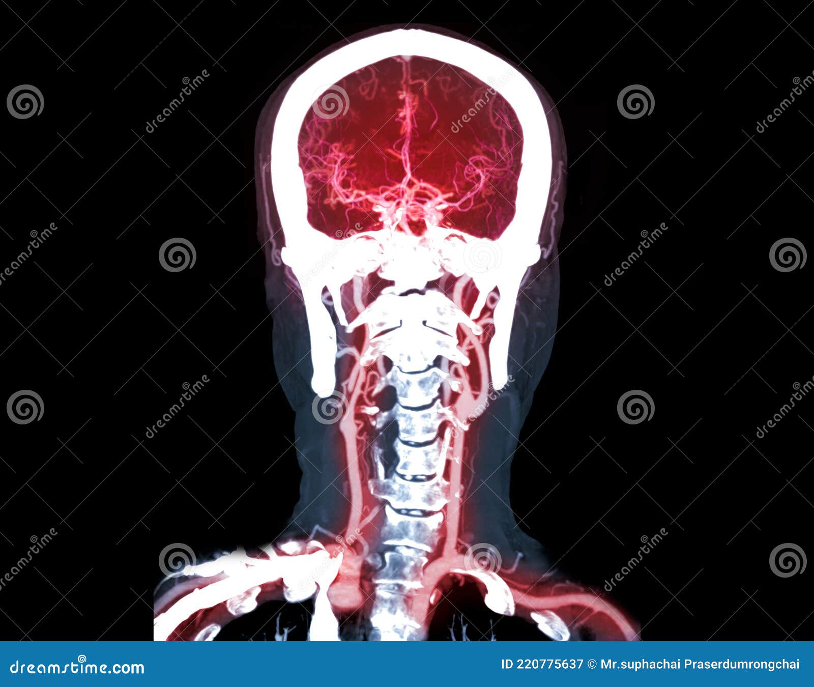 CTA Brain or CT Angiography of the Brain Mip Technique Coronal View for ...