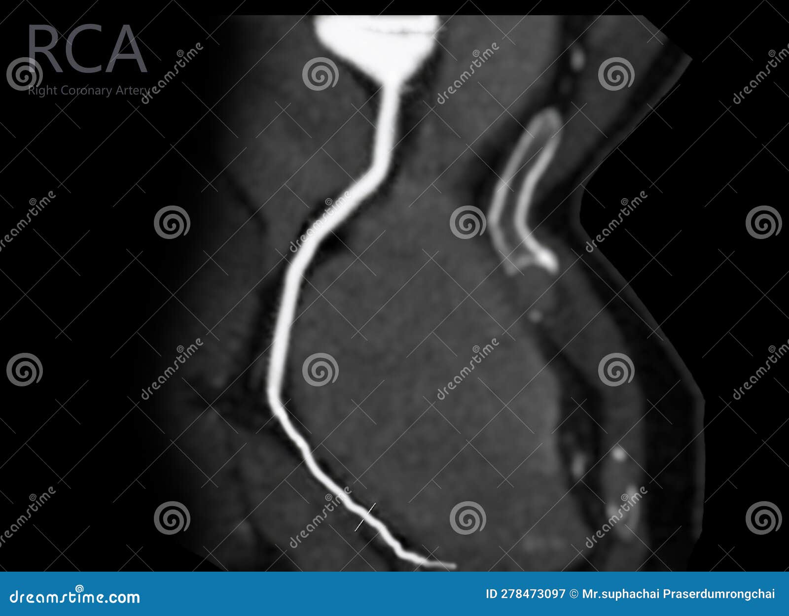 CTA Coronary Artery Curve Refomation Showing Right Coronary Artery ...
