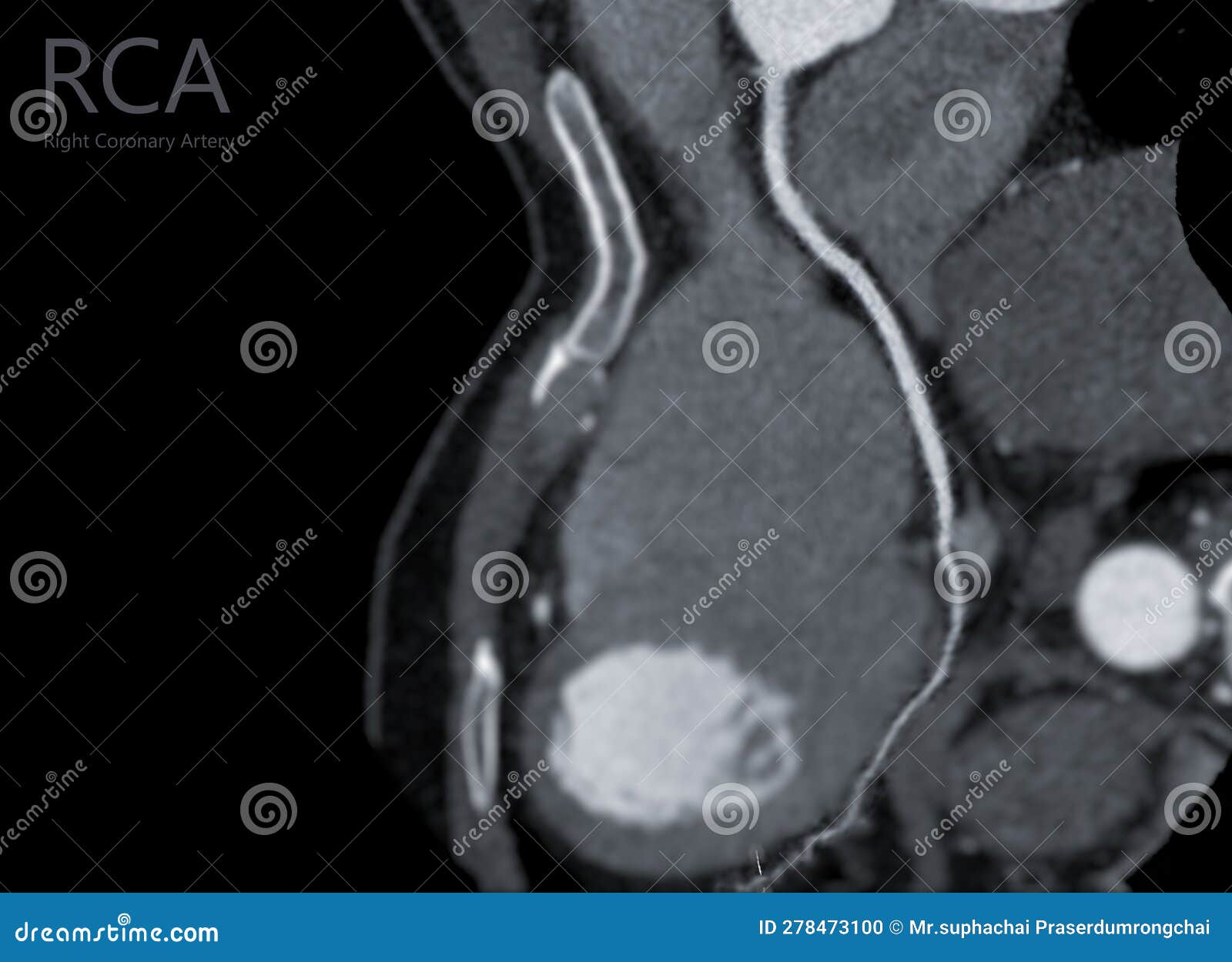 CTA Coronary Artery Curve Refomation Showing Right Coronary Artery ...