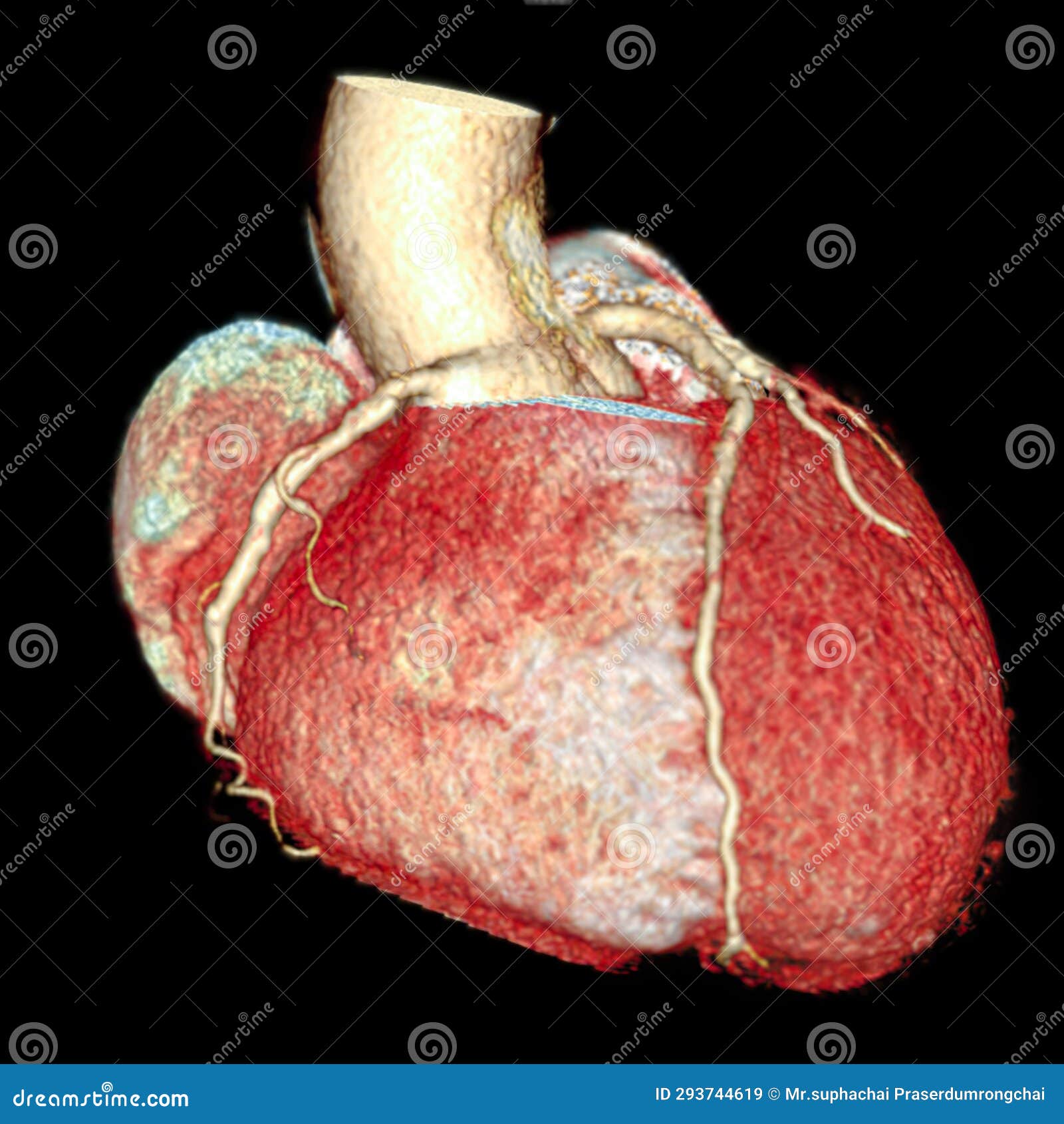 CTA Coronary Artery 3D Rendering Image. CT Angiographphy for Heart ...