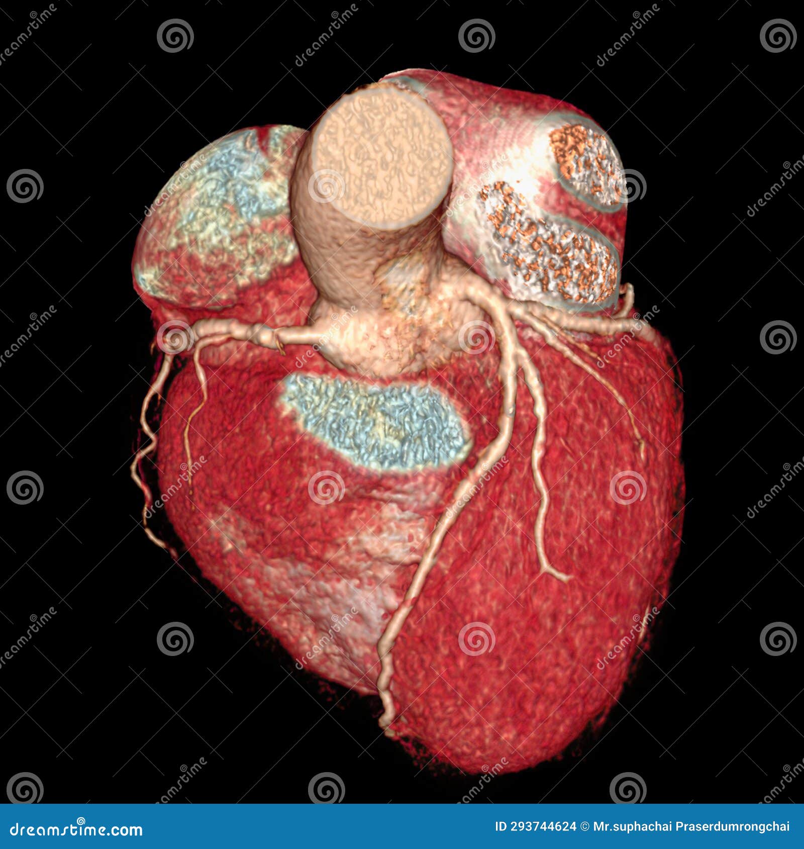 CTA Coronary Artery 3D Rendering Image. CT Angiographphy for Heart ...