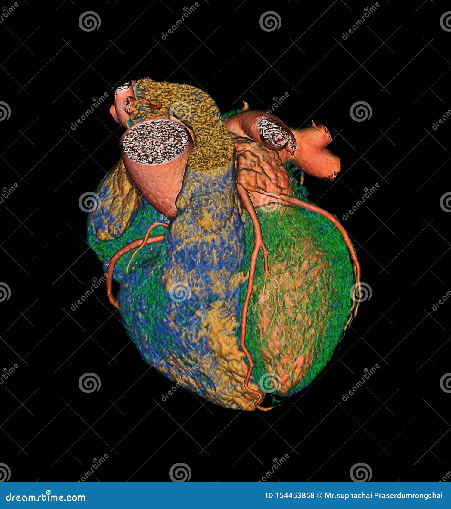 CTA Coronary Artery 3D Rendering Image. Stock Illustration ...