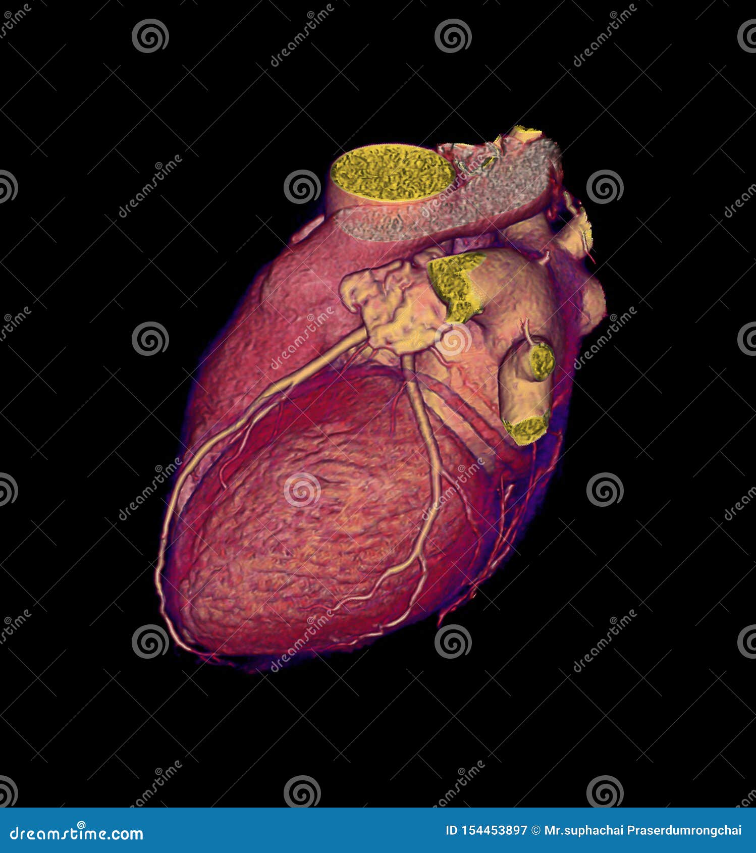 CTA Coronary Artery 3D Rendering Image. Stock Illustration ...