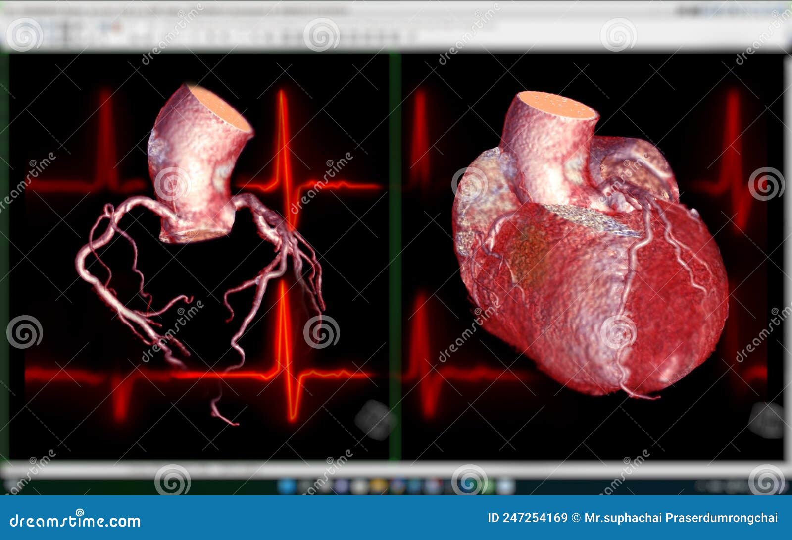 CTA Coronary Artery 3D Rendering Image on the Screen for Diagnosis of ...