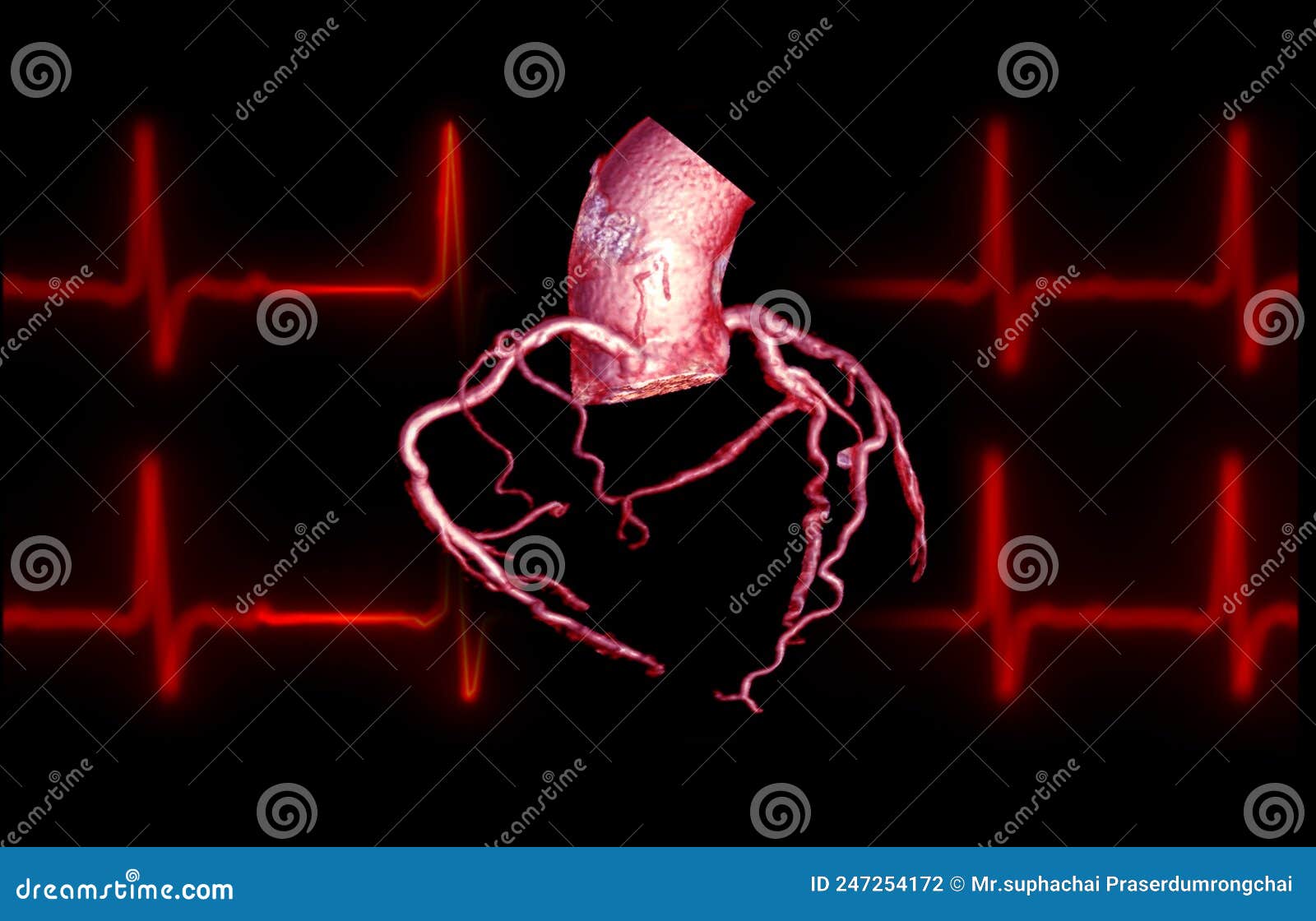 CTA Coronary Artery 3D Rendering Image on the Screen for Diagnosis of ...