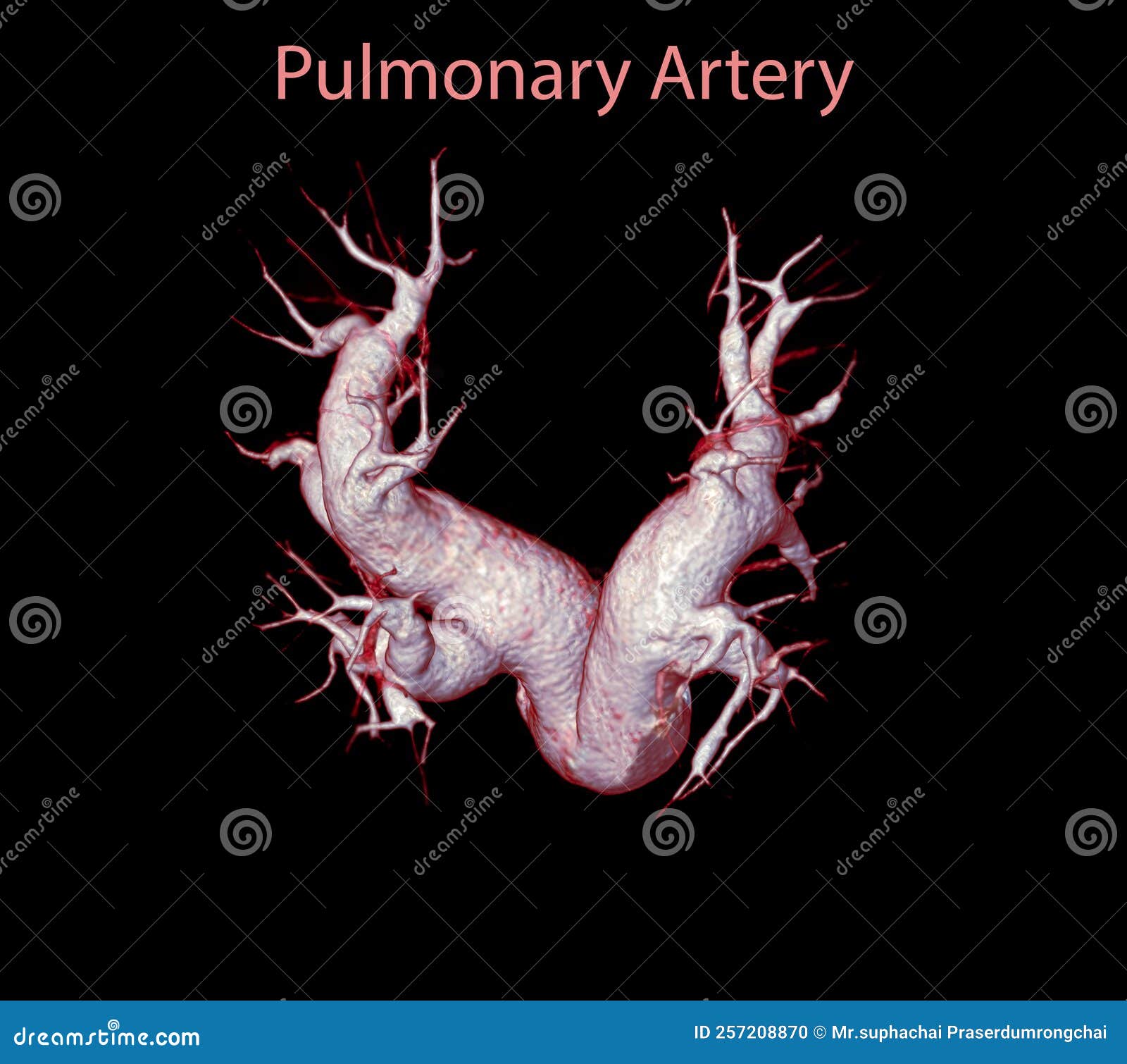 CTA pulmonary arteries 3D stock illustration. Illustration of embolus ...