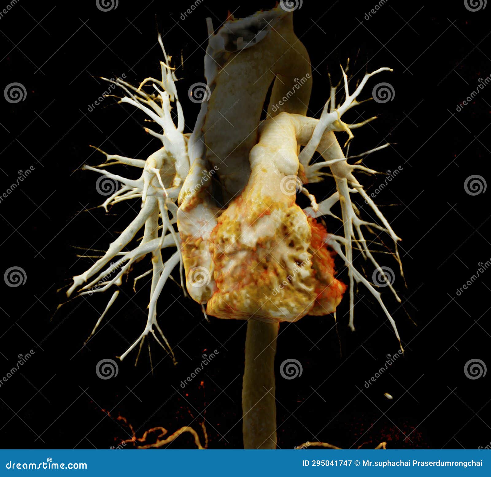CTA Pulmonary Artery or CTPA with Contrast Media 3D Rendering Normal ...