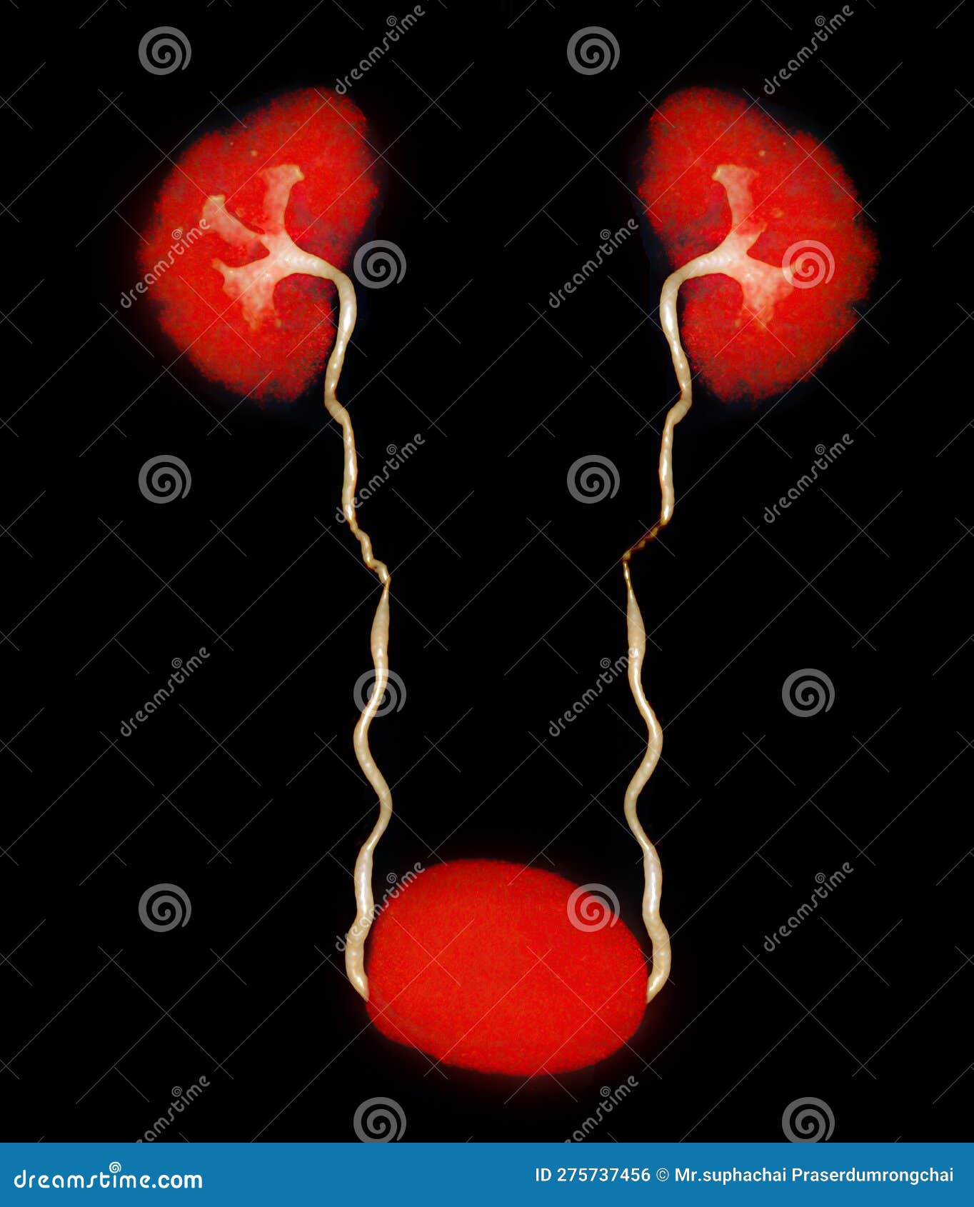 CTA Renal Artery 3D Rendering Image Showing Both Kidney, Ureter and ...