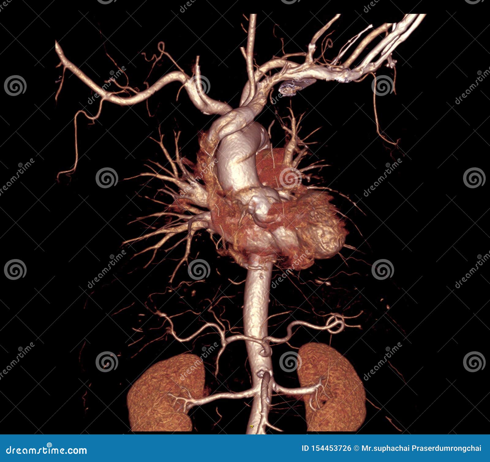 CTA Thoracic Aorta 3D Rendering Image Stock Photo - Image of radiology ...