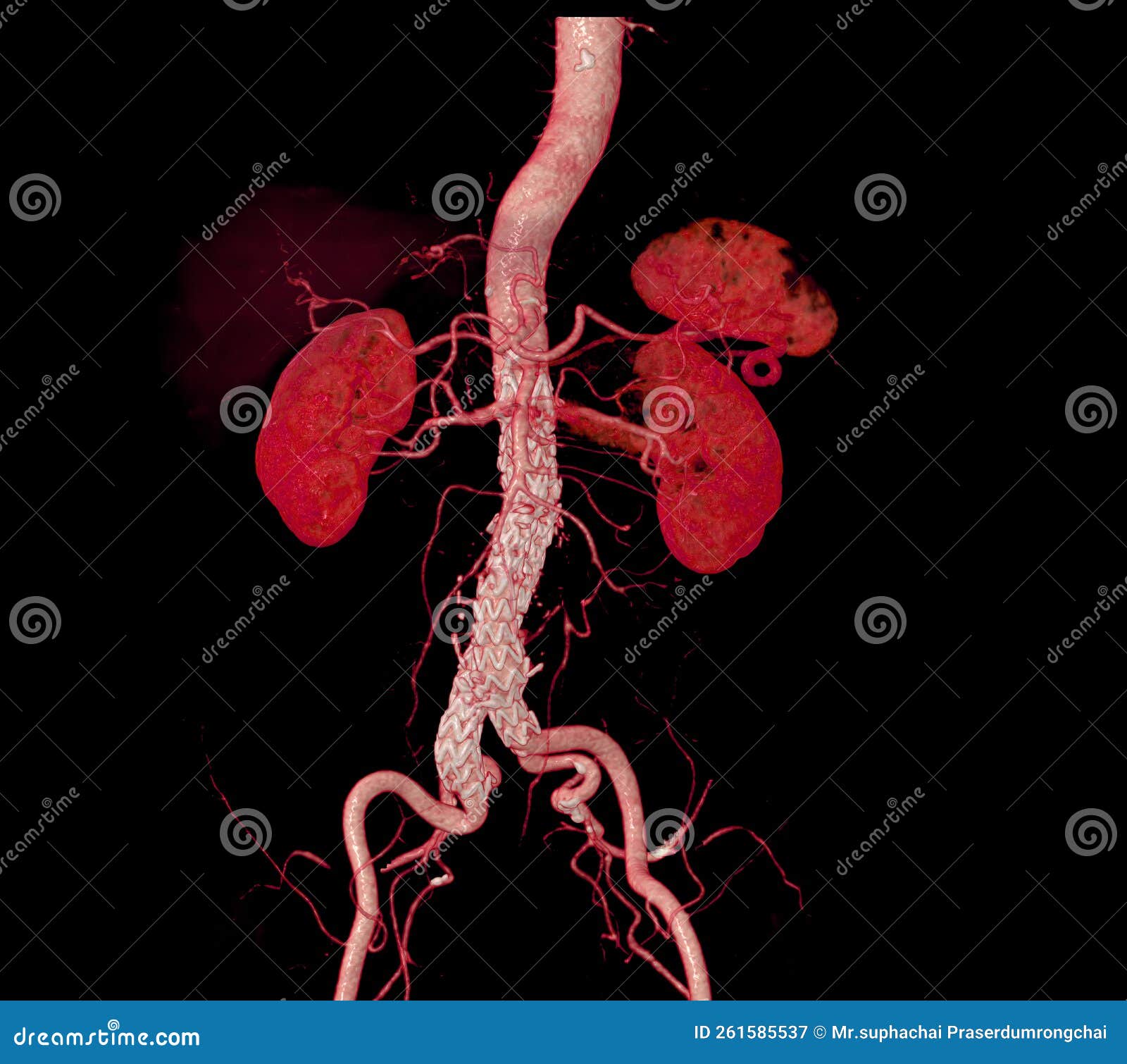 CTA Whole Aorta with Abdominal Aorta Stent Graft Compare 3D Rendering ...