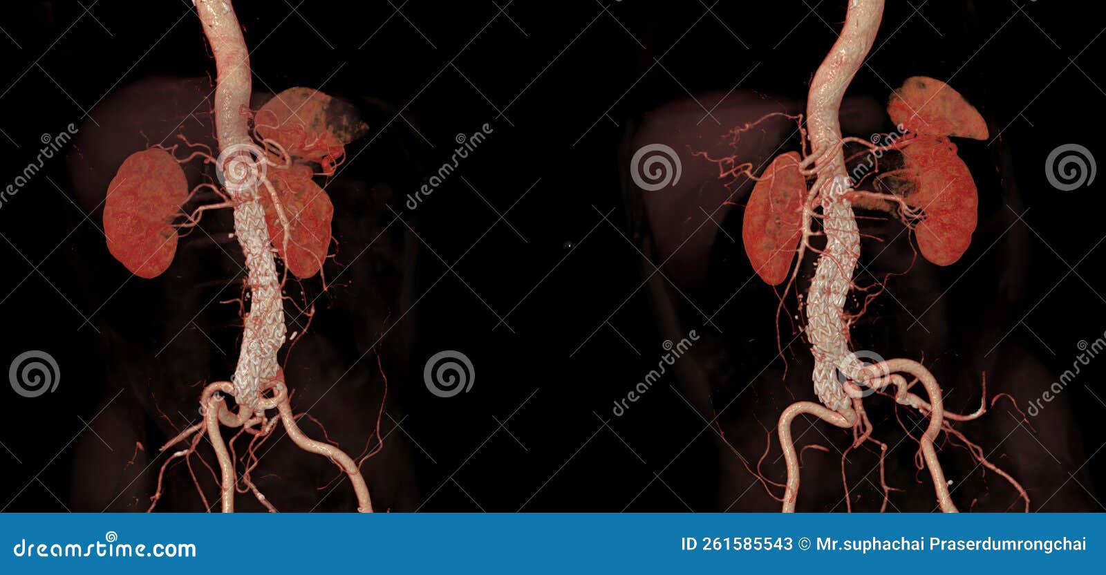 CTA Whole Aorta with Abdominal Aorta Stent Graft Compare 3D Rendering ...