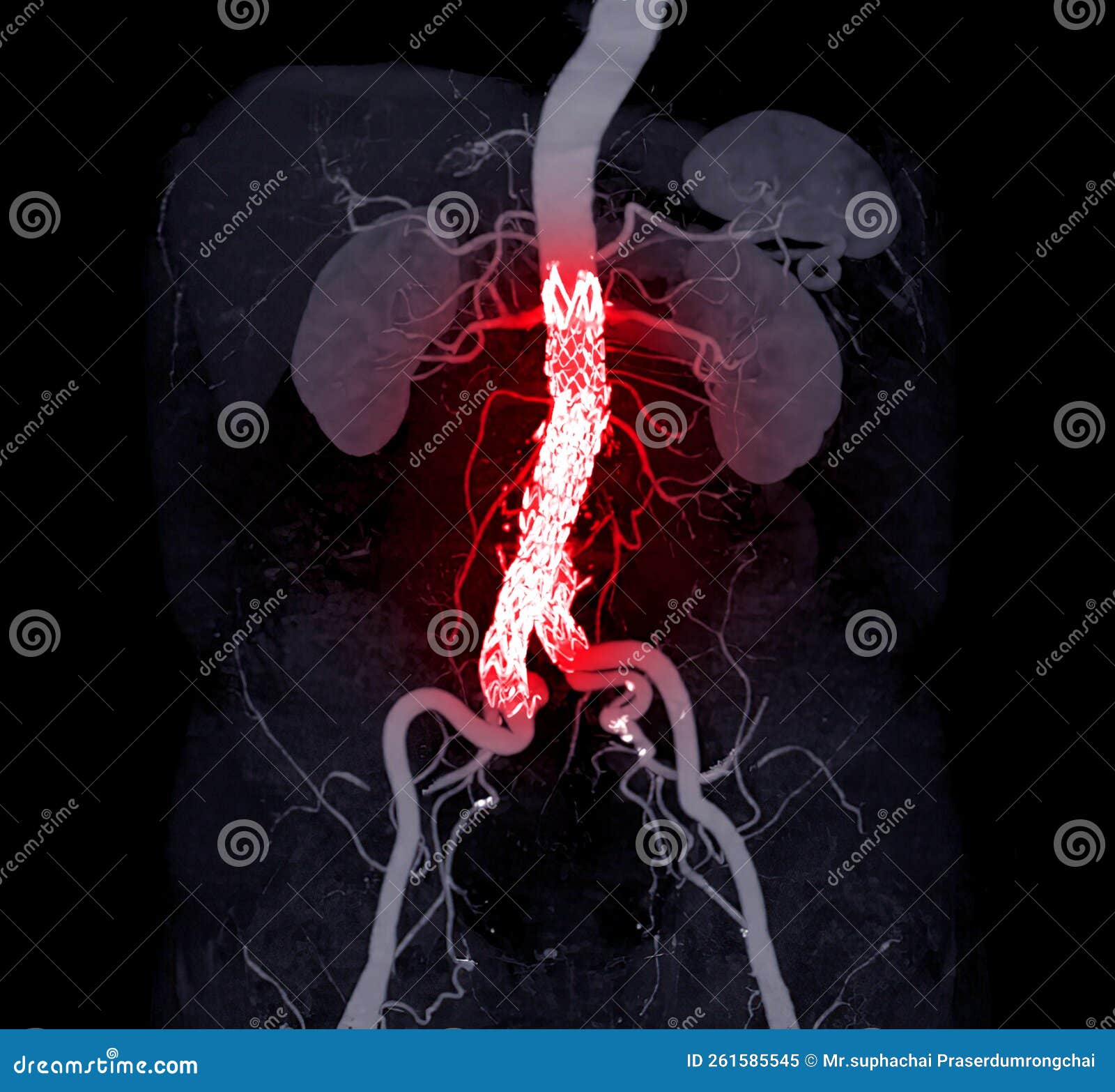 Cta Whole Aorta With Abdominal Aorta Stent Graft Compare 3d Rendering