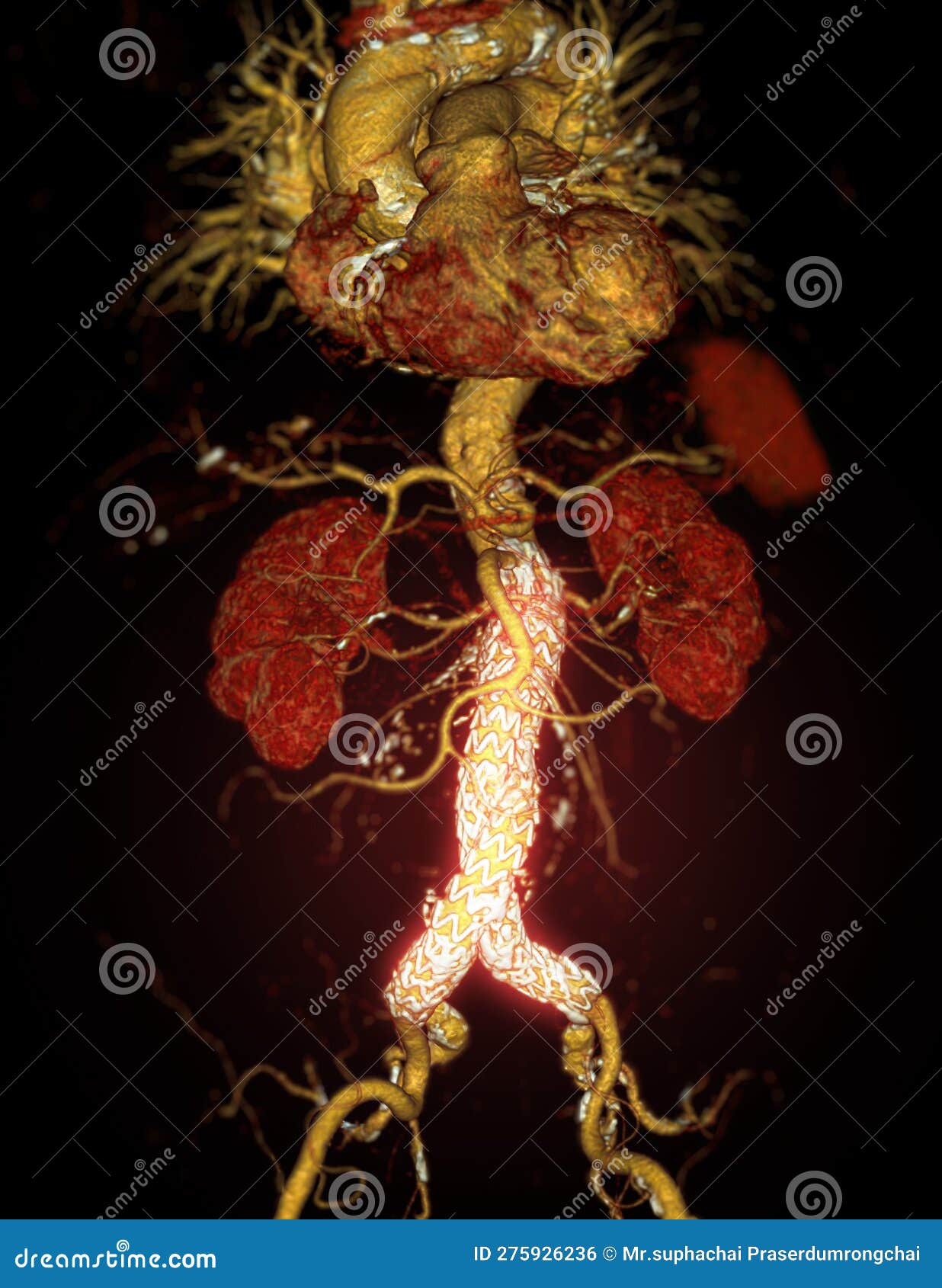 CTA Whole Aorta with Abdominal Aorta Stent Graft 3D Rendering Image in ...