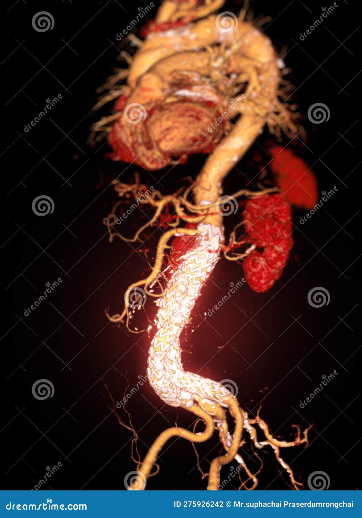 Cta Whole Aorta With Abdominal Aorta Stent Graft 3d Rendering Image In