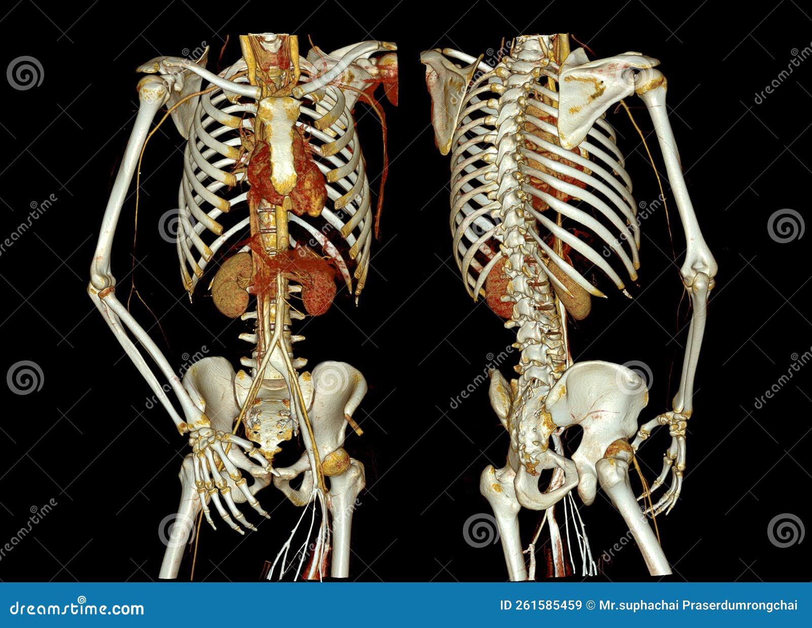 CTA Whole Aorta and Brachial Artery 3D Rendering Image in Case Patient ...