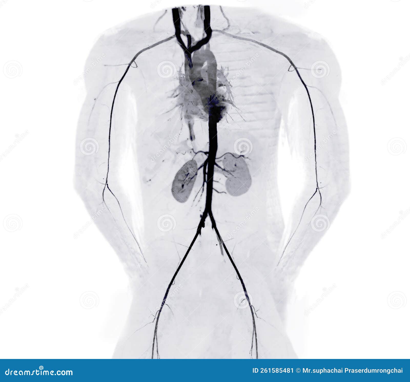 CTA Whole Aorta and Brachial Artery 3D Rendering Image in Case Patient ...