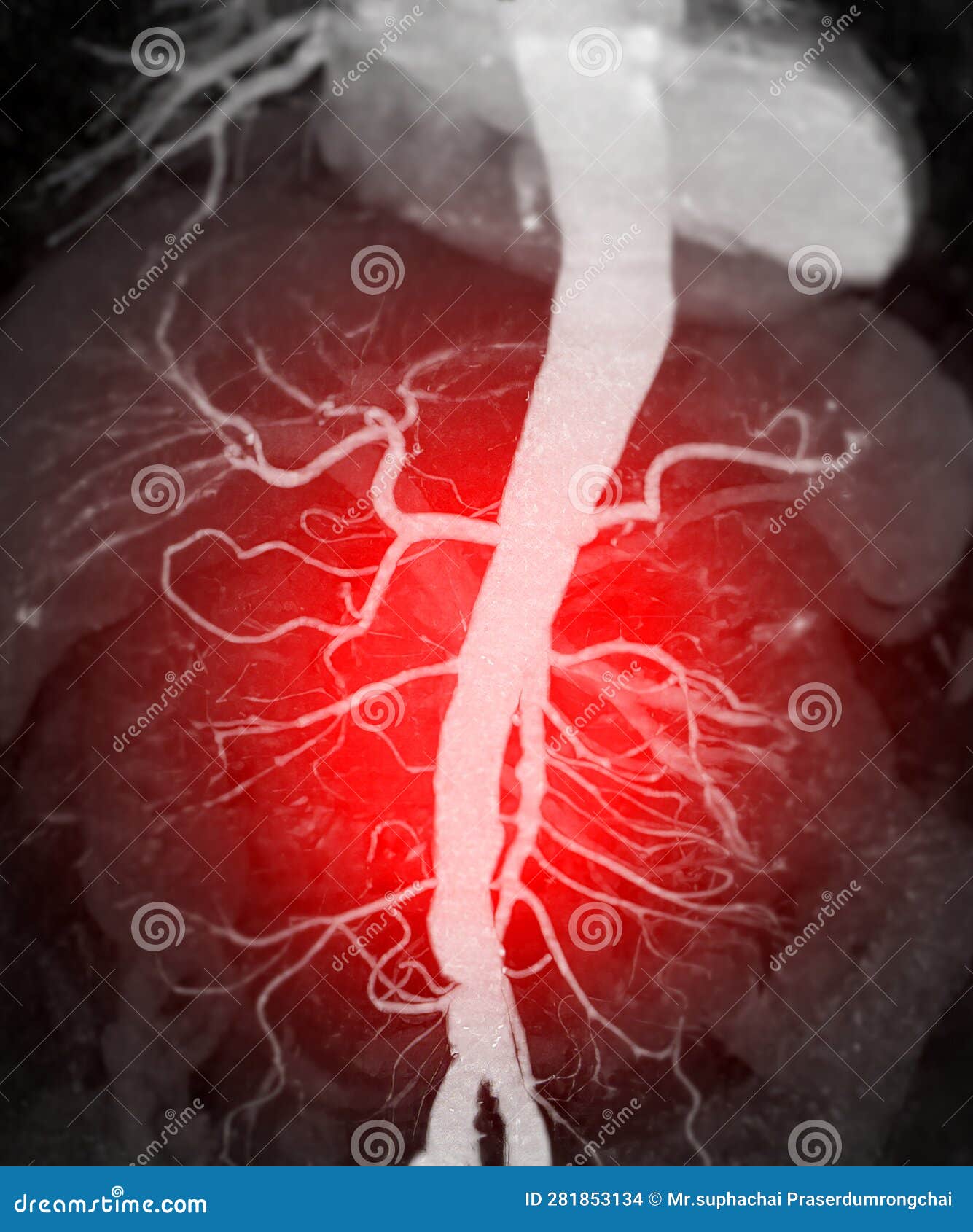 CTA Whole Aorta With Abdominal Aorta Stent Graft Compare 3D Rendering ...