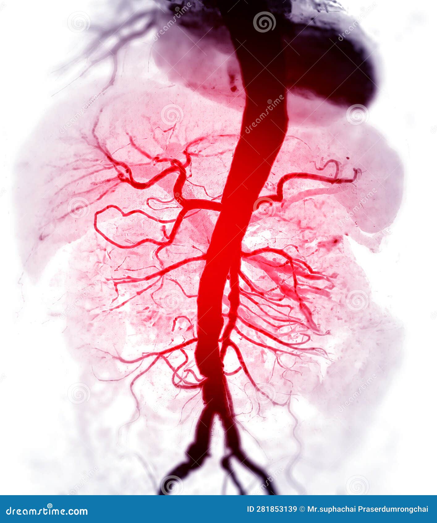 CTA Whole Aorta With Abdominal Aorta Stent Graft Compare 3D Rendering ...