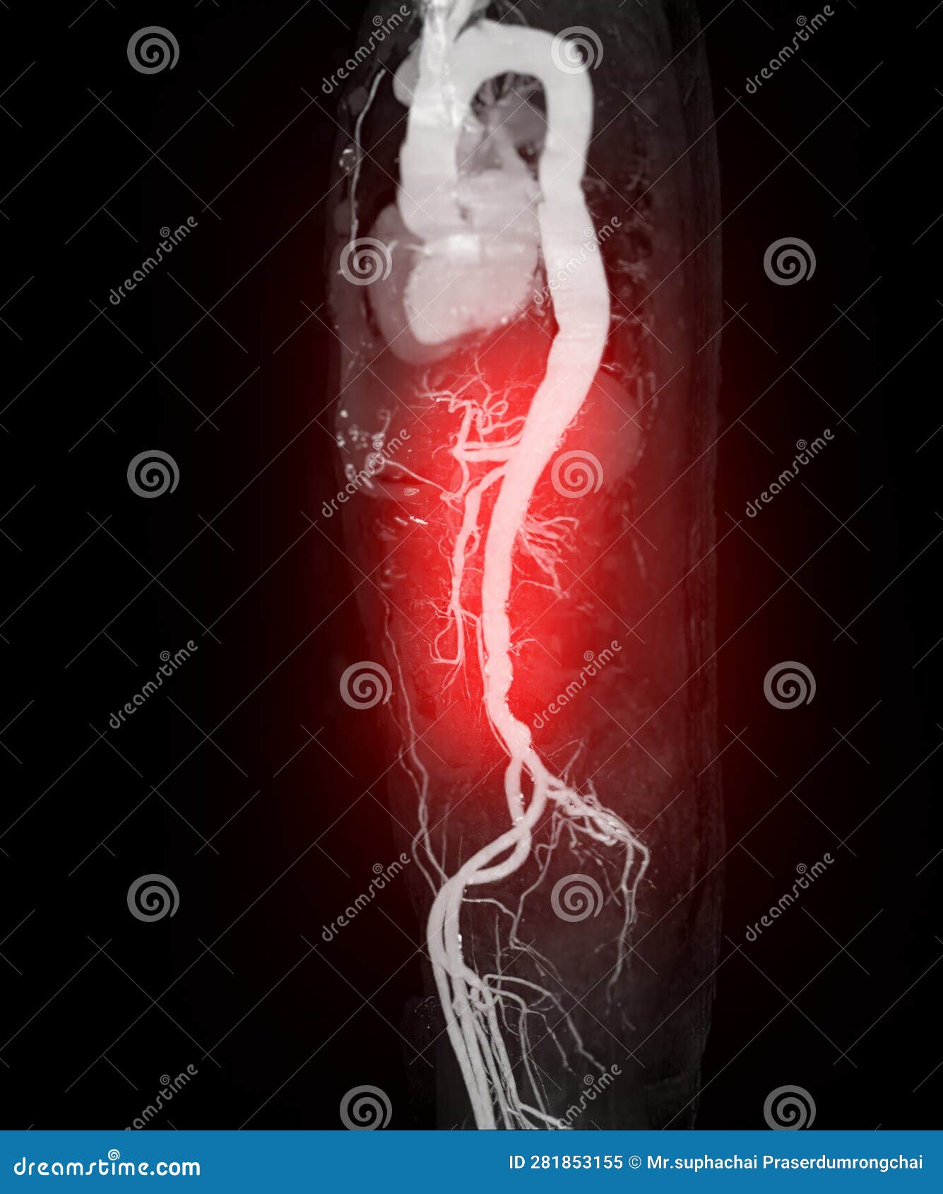 Cta Whole Aorta 3d Rendering Stock Illustration Illustration Of Equipment Artery 281853155