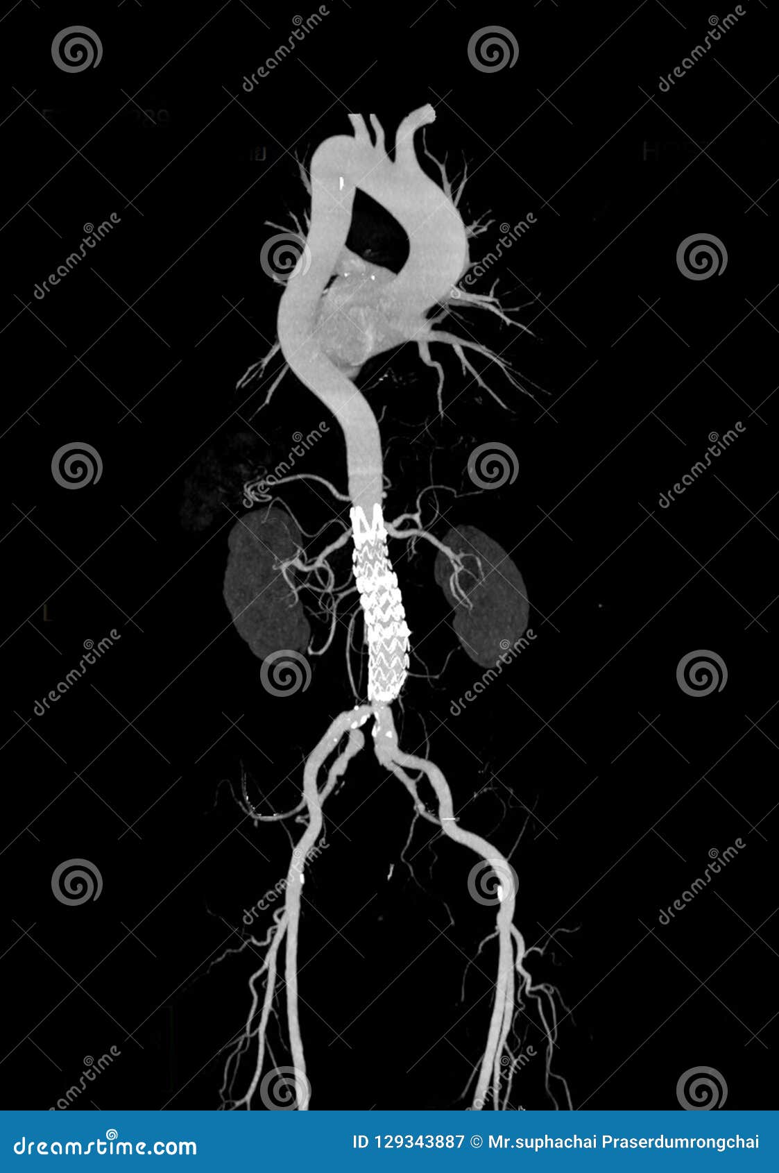 Cta Whole Aorta With Thoracic Aorta Stent Graft 3d Rendering Image
