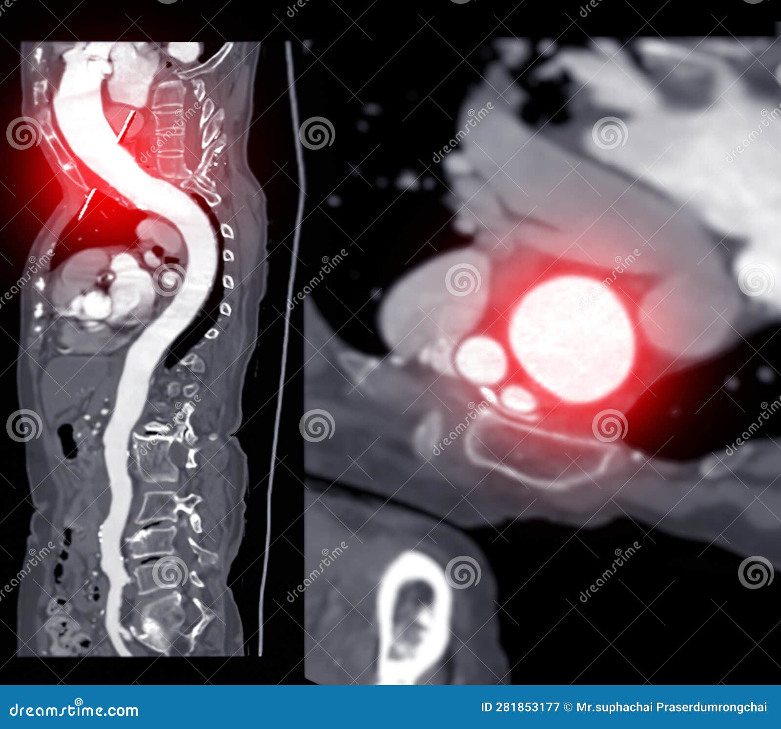 CTA whole aorta MPR Curve stock image. Image of cardiovascular - 281853177