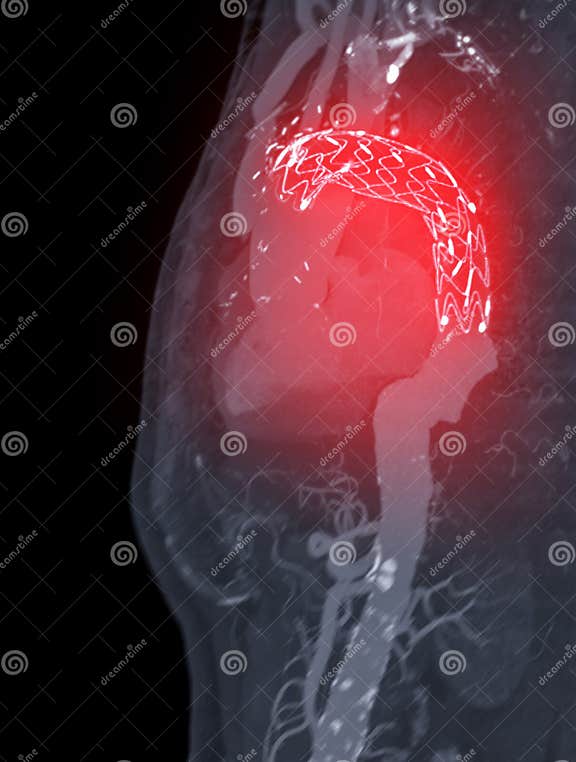 Cta Whole Aorta With Thoracic Aorta Stent Graft 3d Rendering Image