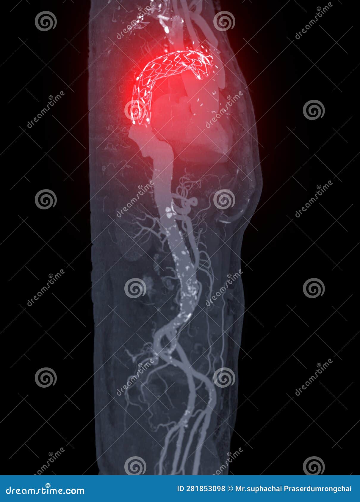 CTA Whole Aorta with Thoracic Aorta Stent Graft . Stock Illustration ...