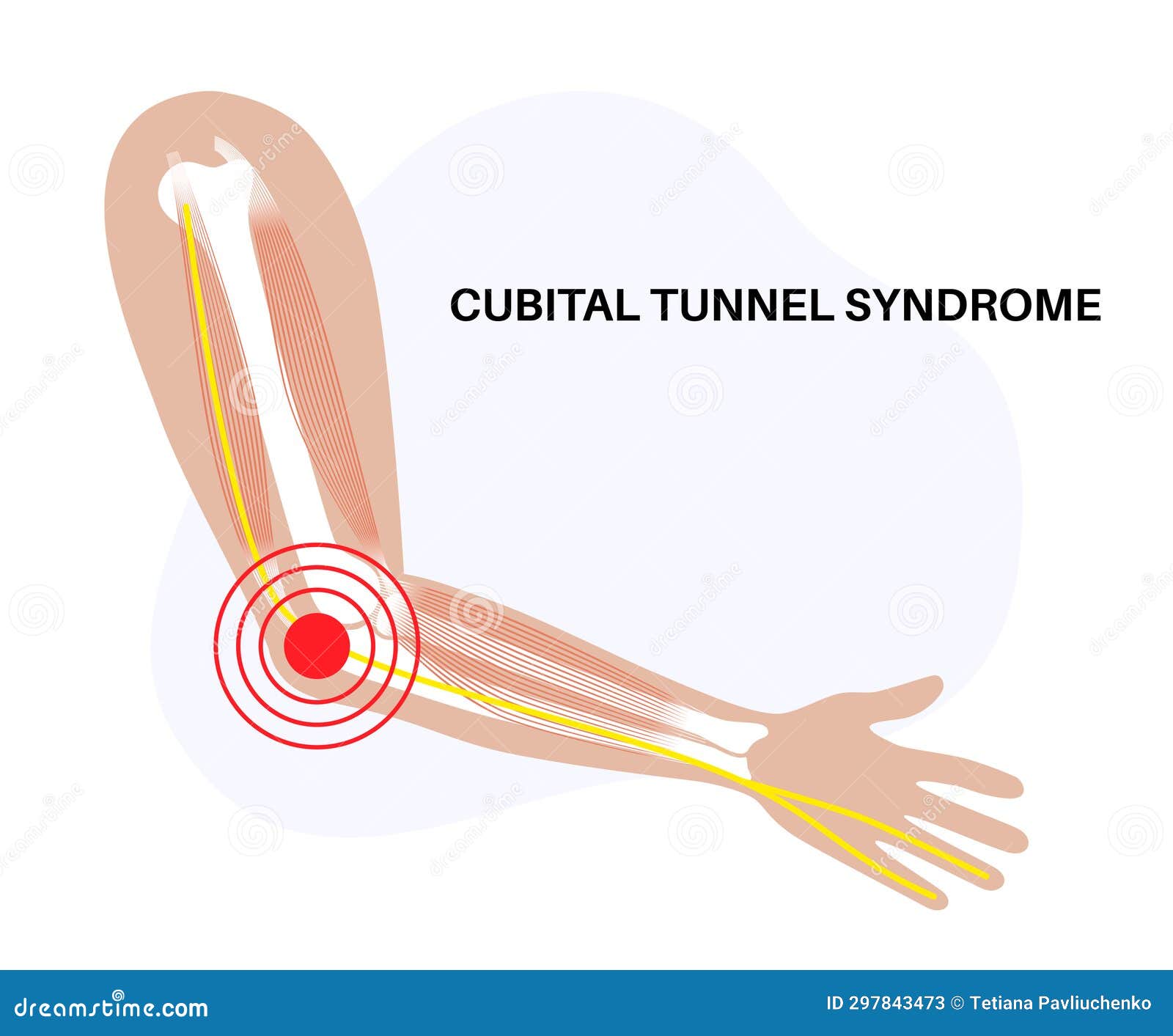 Cubital Tunnel Syndrome Cartoon Vector | CartoonDealer.com #296432649