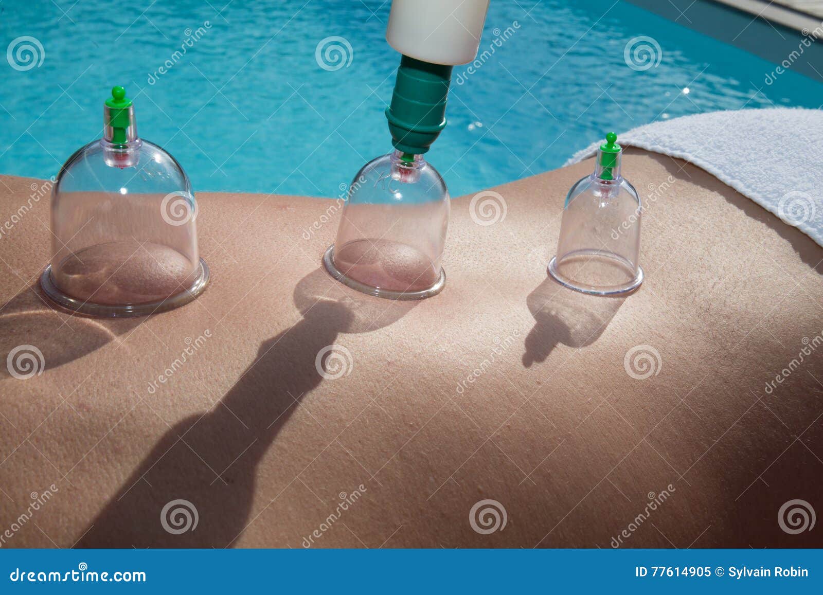 Cupping Massage at Spa Center, a Chinese Therapy Stock Image - Image of ...