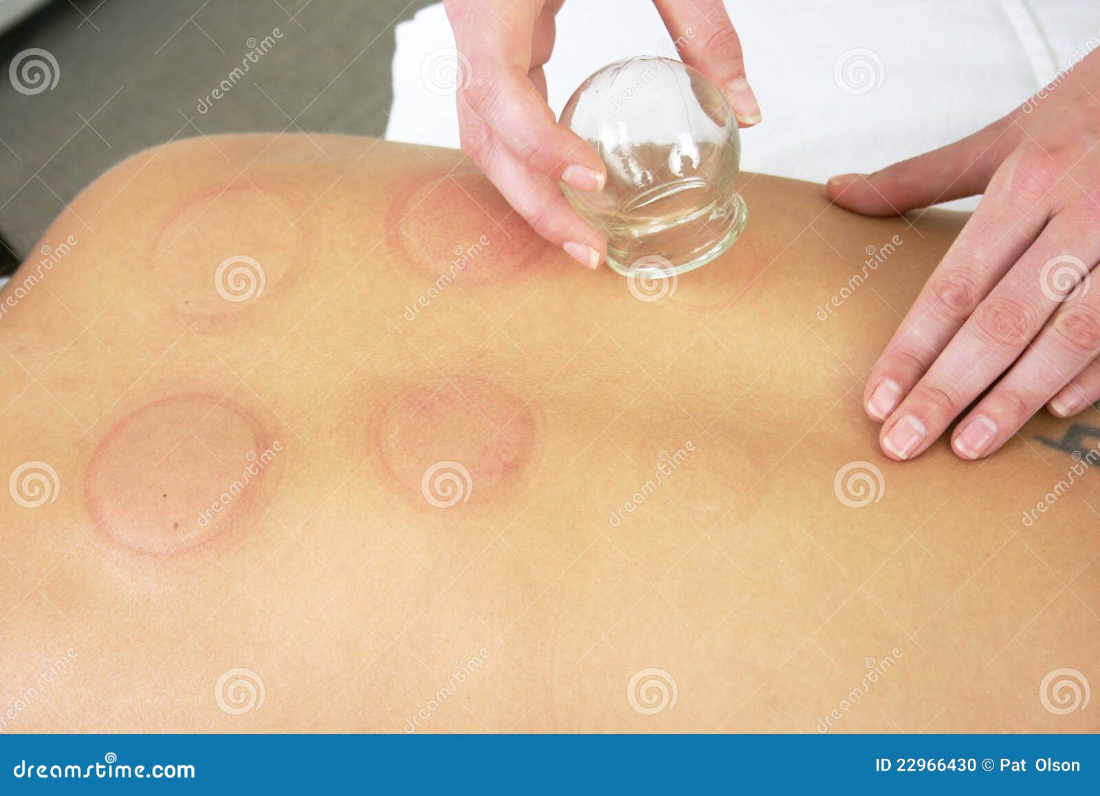 Cupping spa treatment stock photo. Image of alternative - 22966430