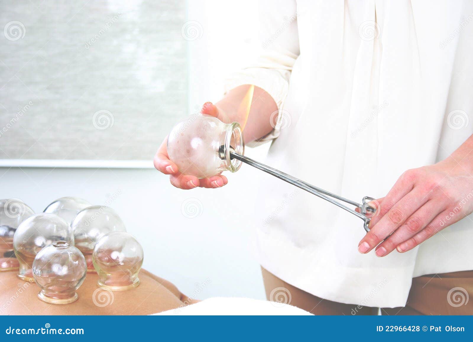 Cupping treatment at spa stock photo. Image of caucasian - 22966428