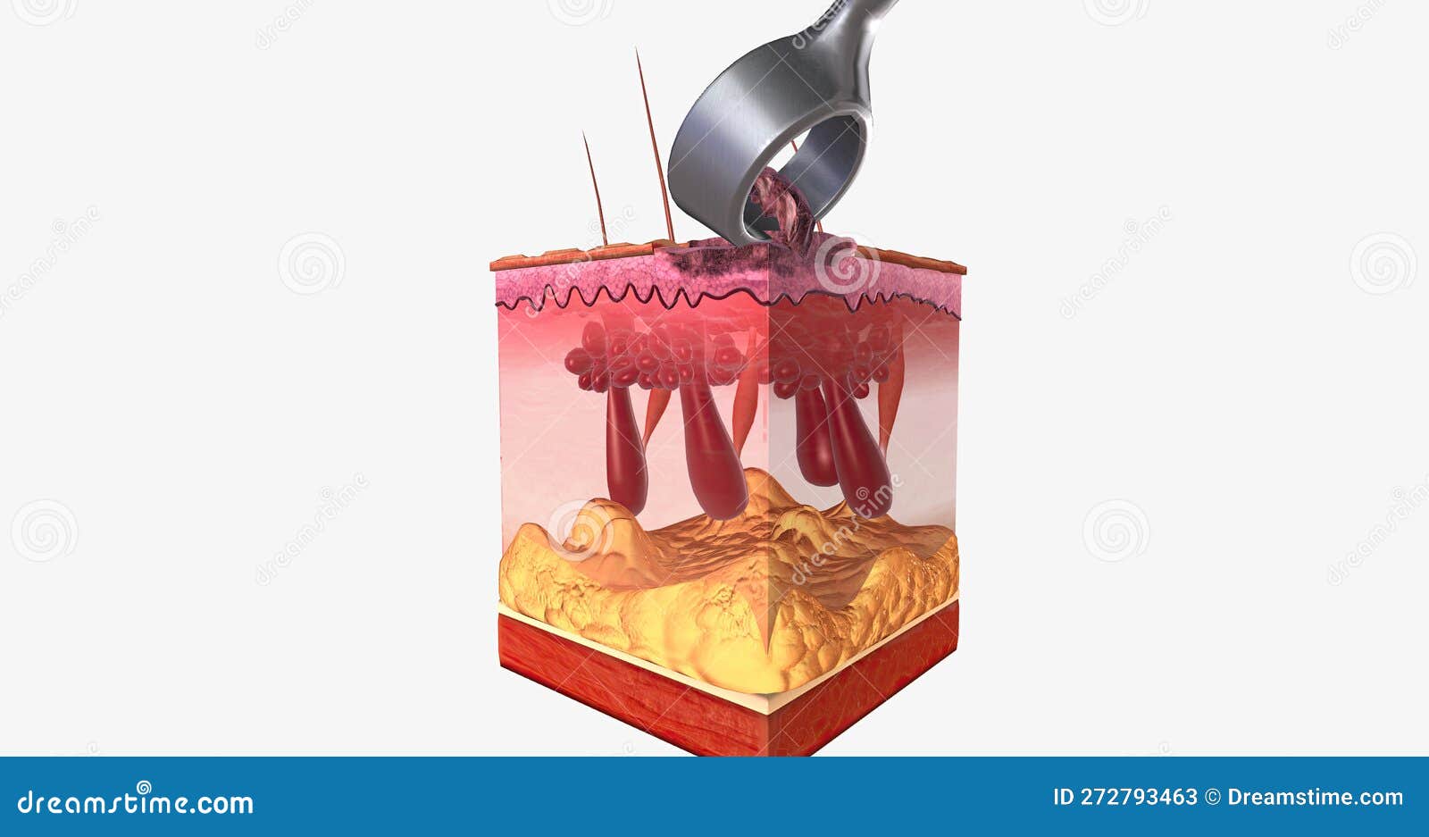 The Curettage and Electrodesiccation Close Up Stock Illustration ...