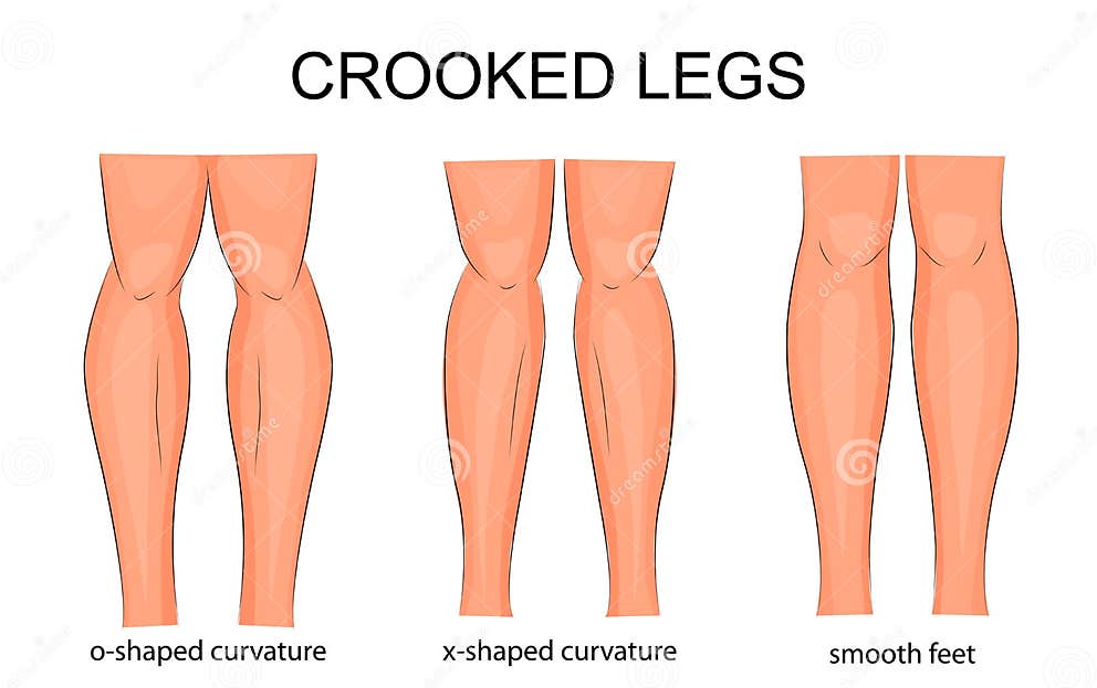 Curvature of the legs stock vector. Illustration of orthopaedics - 73141835