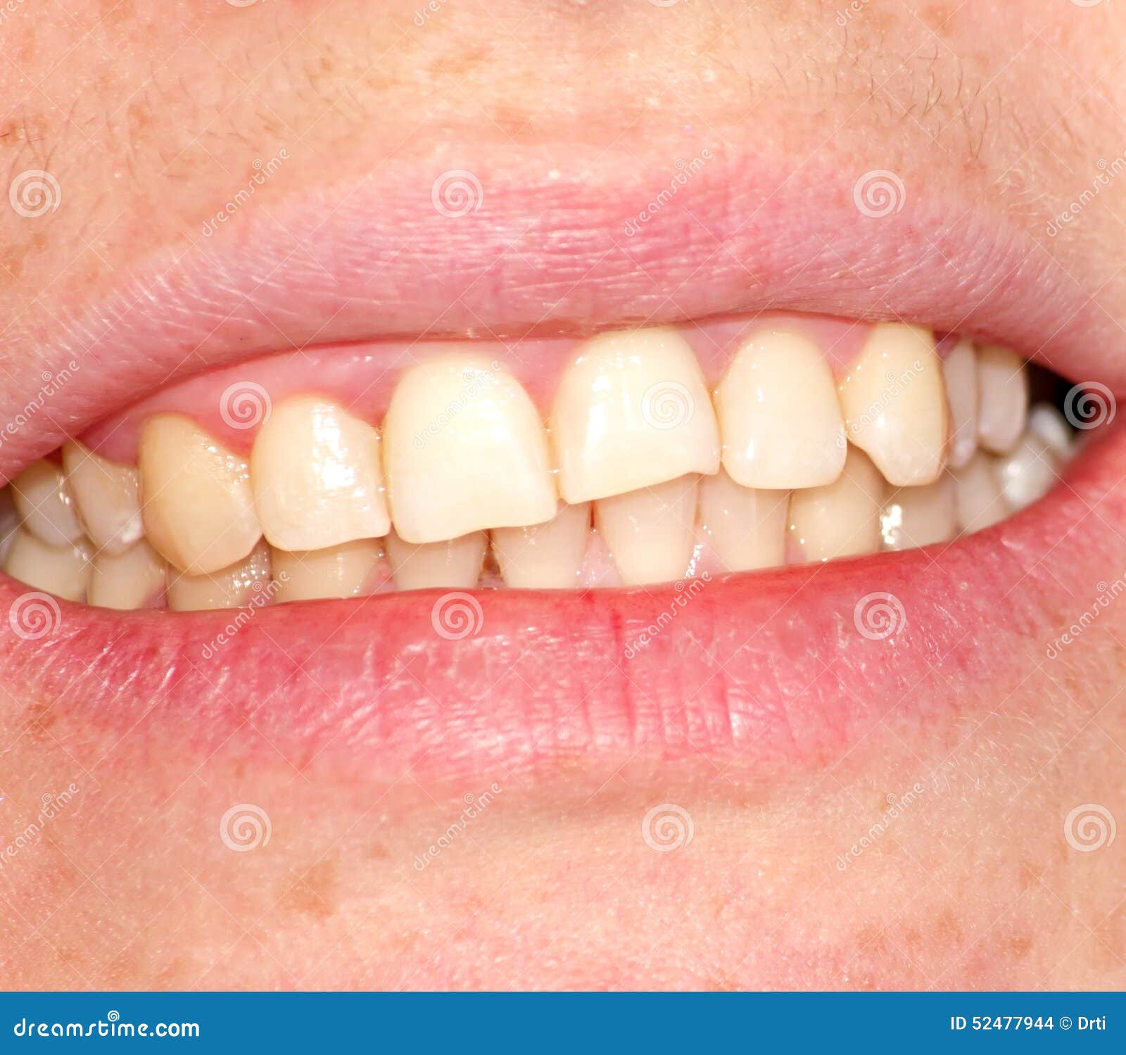 Malocclusion, Overcrowding Of Both Upper And Lower Teeth Royalty-Free ...