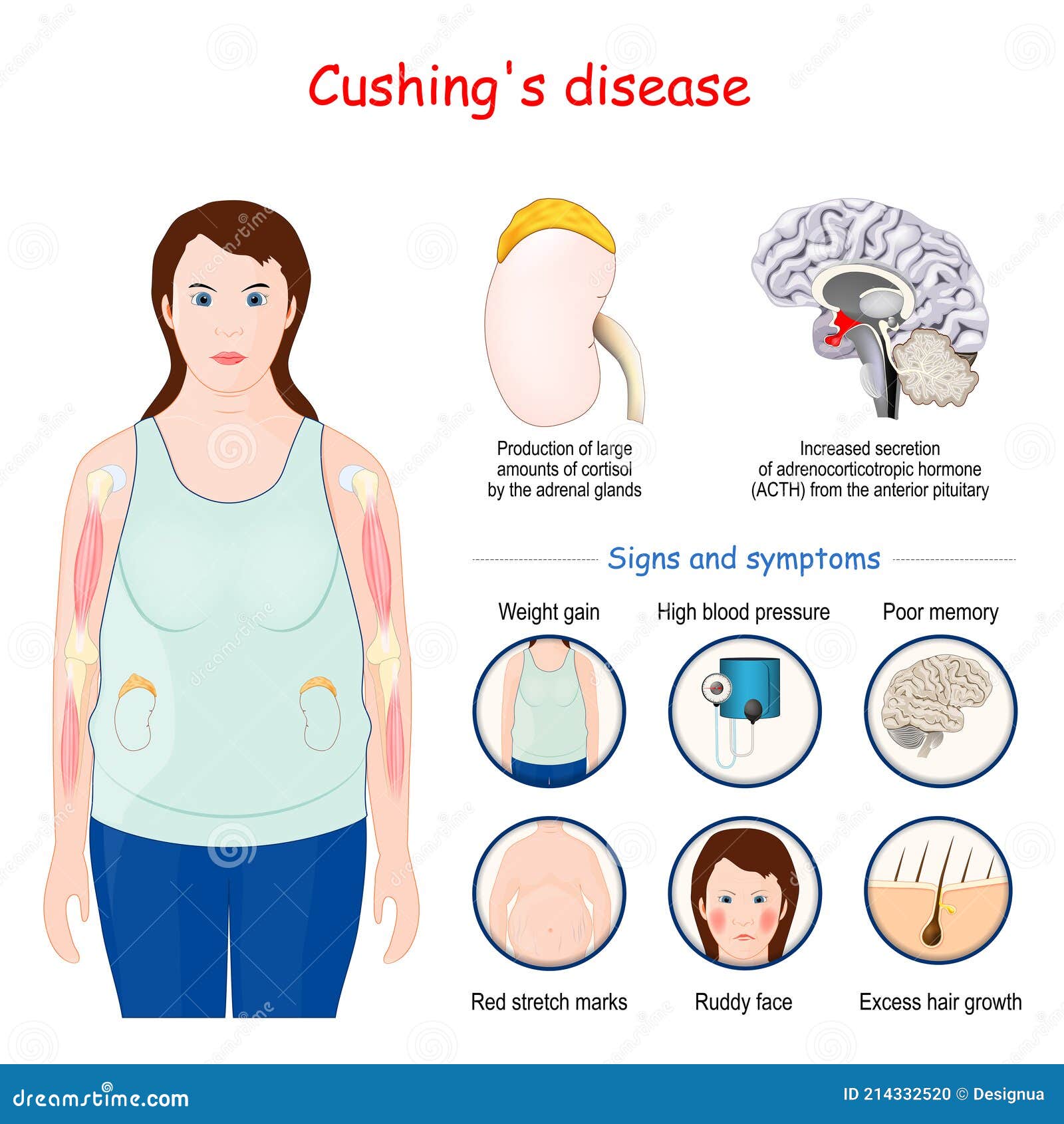 Cushing`s Disease. Signs and Symptoms of Cushing Syndrome Stock Vector ... Cushing`s Disease. Signs and Symptoms of Cushing Syndrome Stock Vector ...