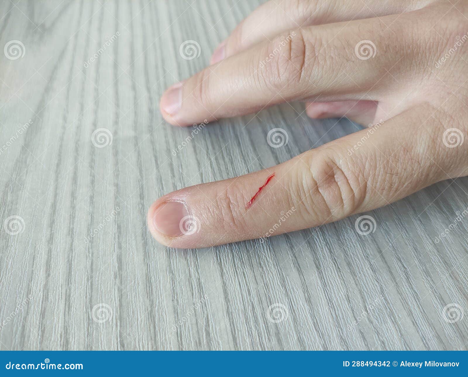 Cut Finger Close Up. Finger Wound. Stock Photo - Image of injury ...
