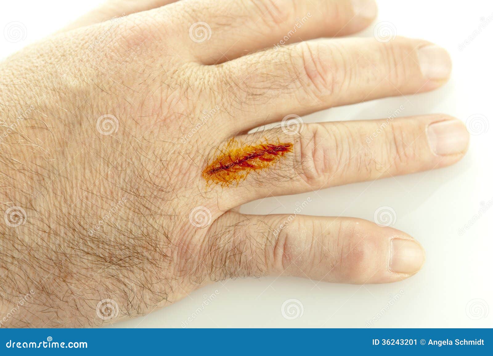 Cut on Hand stock image. Image of skin, disinfect, applying - 36243201