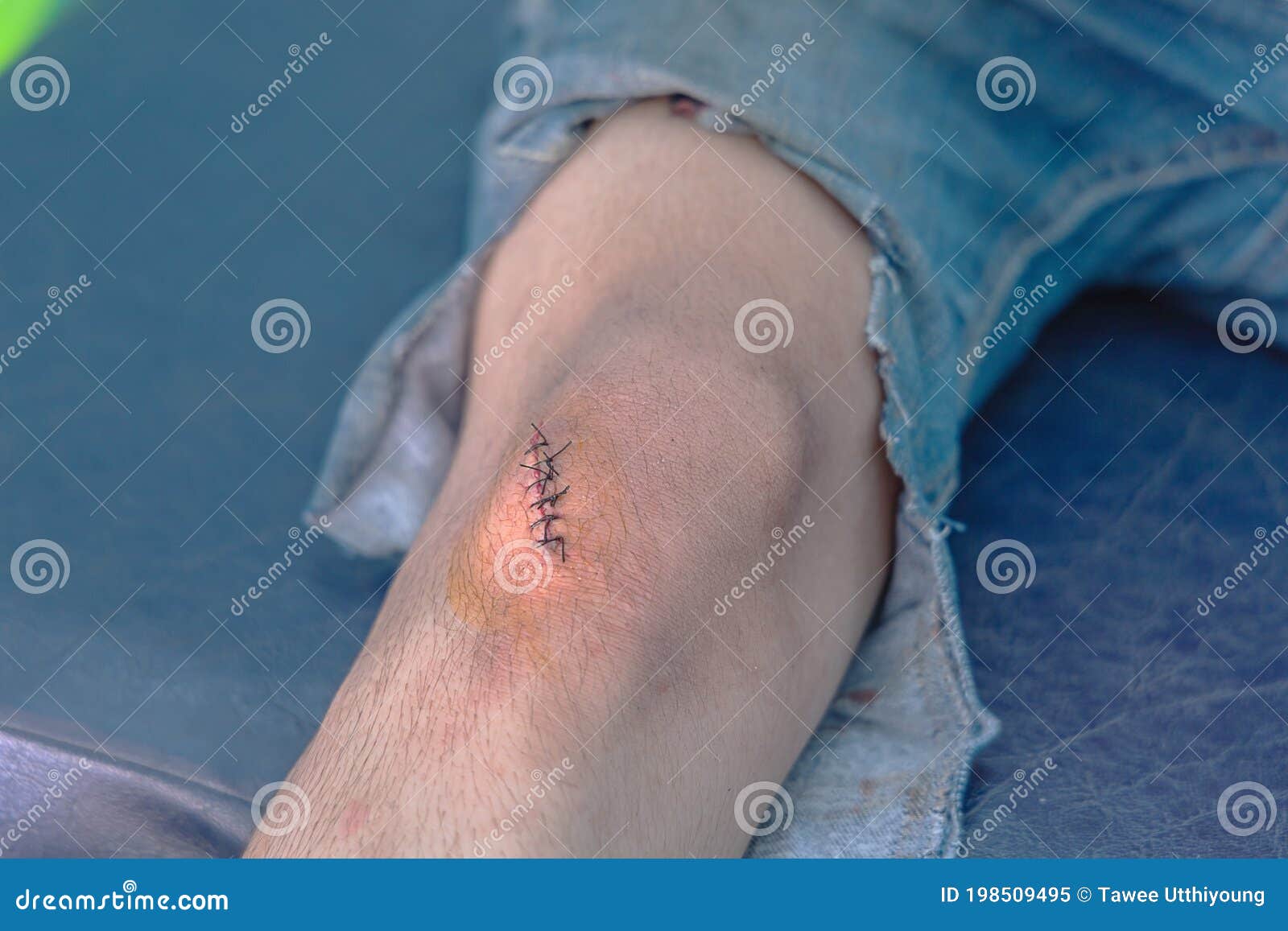 Cut Wound Dressing,cut Wound Surgering Stock Image - Image of injury ...