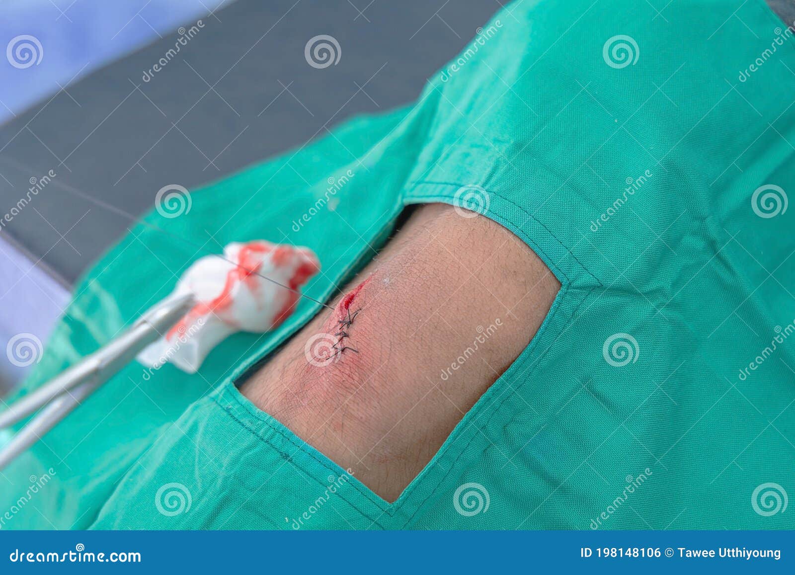 Cut wound surgering stock photo. Image of health, doctor - 198148106