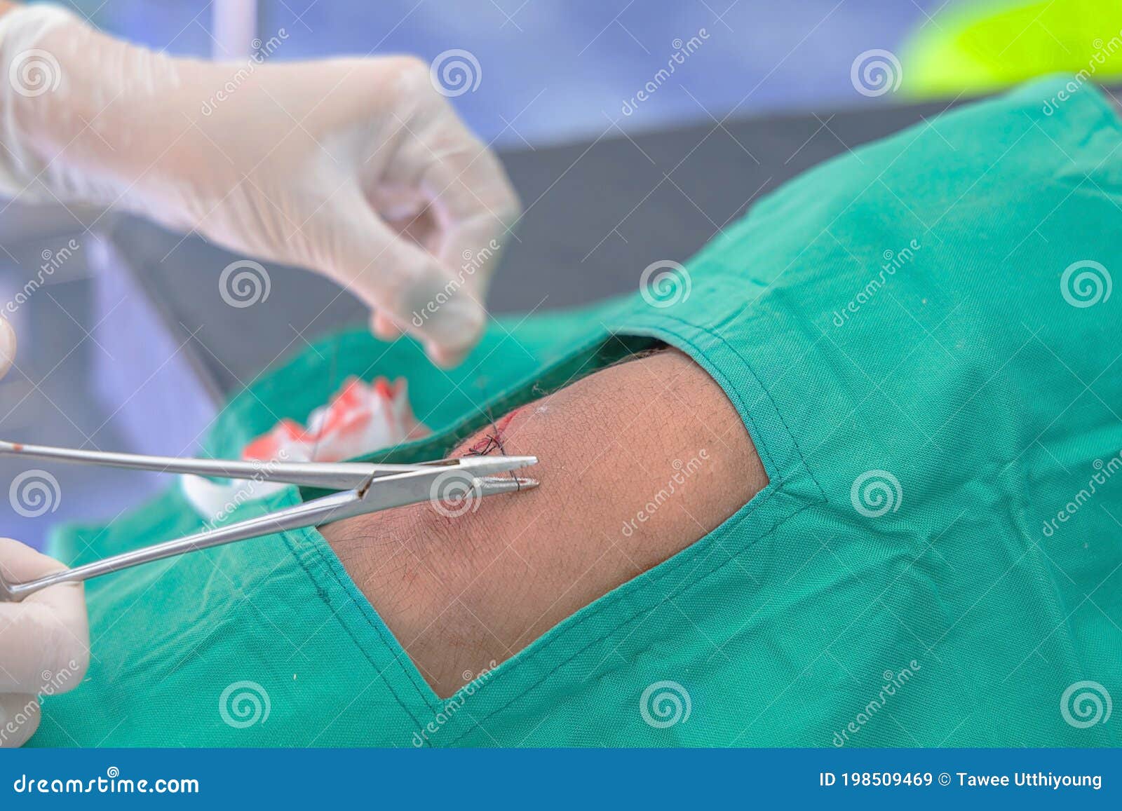 Cut wound surgering stock image. Image of surgery, health - 198509469