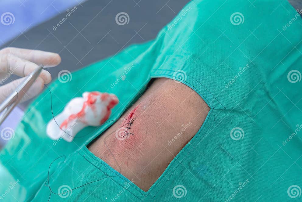 Cut wound dressing stock image. Image of injury, knee - 198509403