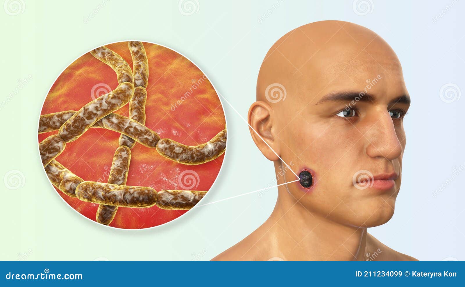 Cutaneous Anthrax, the Most Common Form of Anthrax Stock Illustration ...