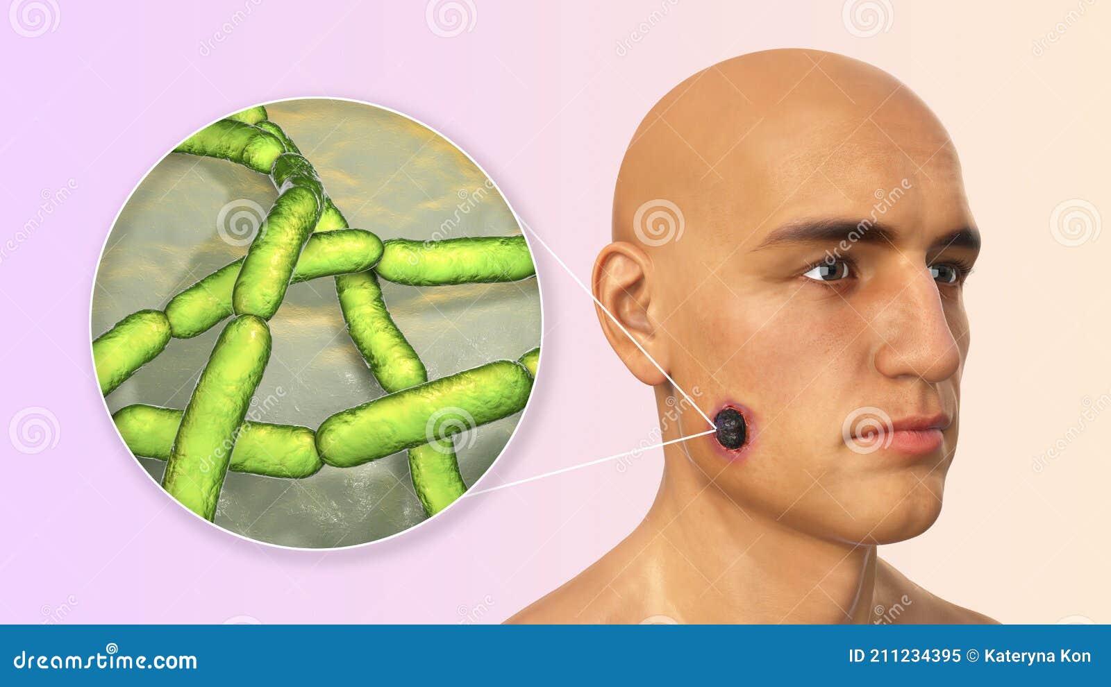 Cutaneous Anthrax, the Most Common Form of Anthrax Stock Illustration ...