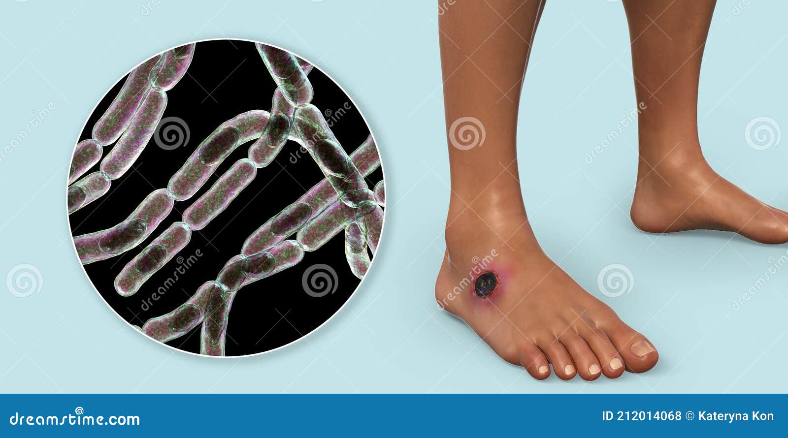 Cutaneous Anthrax, the Most Common Form of Anthrax Stock Illustration ...