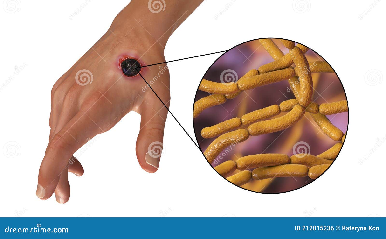 Cutaneous Anthrax, the Most Common Form of Anthrax Stock Illustration ...