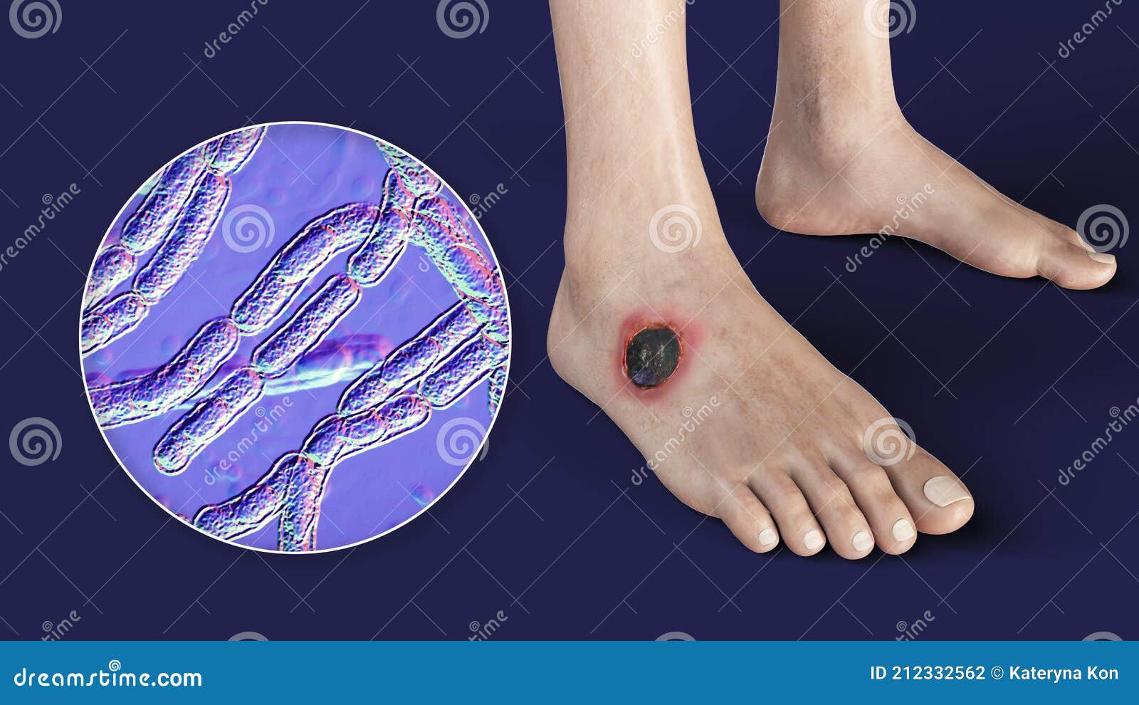Cutaneous Anthrax, the Most Common Form of Anthrax Stock Illustration ...