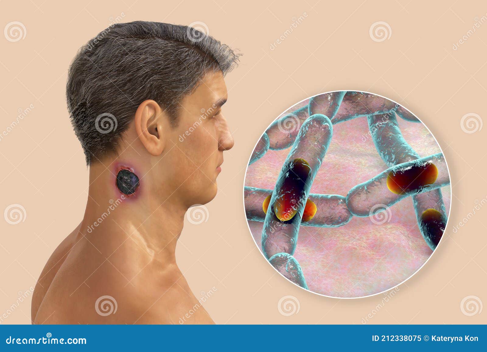 Cutaneous Anthrax, the Most Common Form of Anthrax Stock Illustration ...